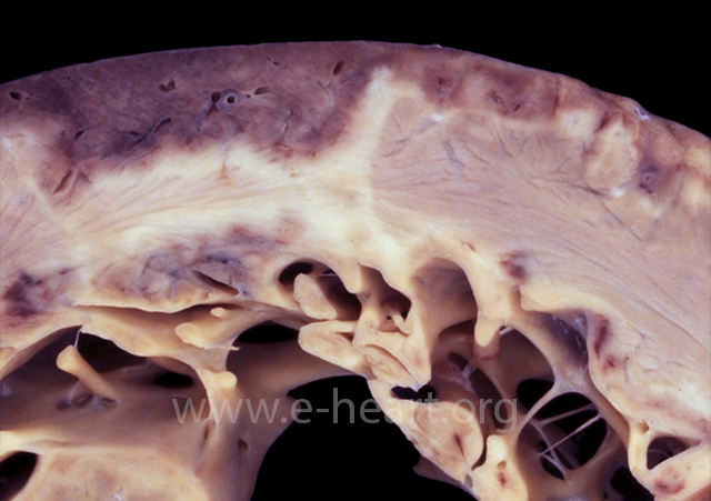 e-heart.org Cardiovascular Pathology Home Page