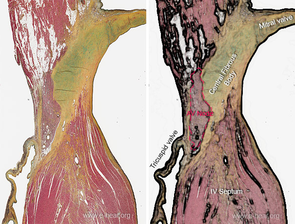 e-heart.org Cardiovascular Pathology Home Page