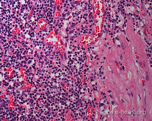 e-heart.org Cardiovascular Pathology Home Page